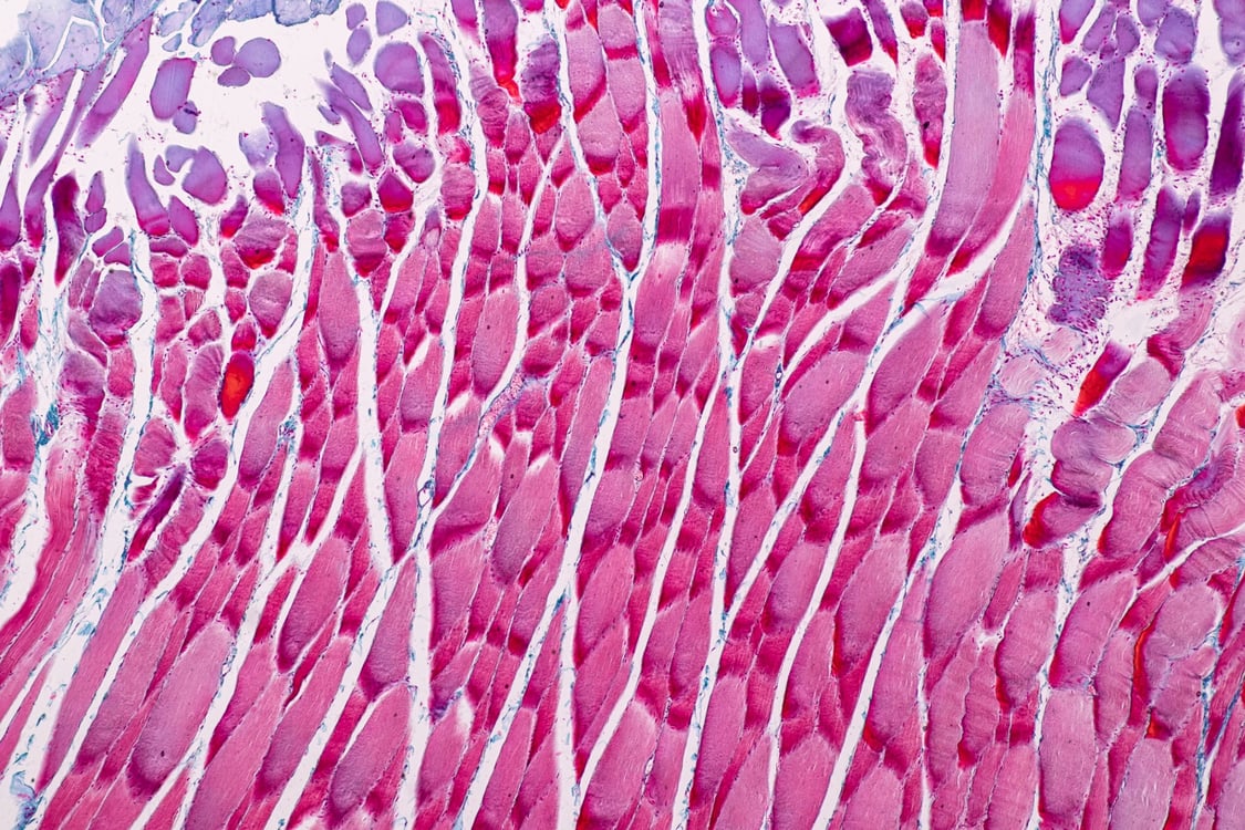 Low Muscle Insulin Sensitivity in Poorly Controlled T2D is Associated ...